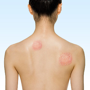 Southern Tick-Associated Rash Illness