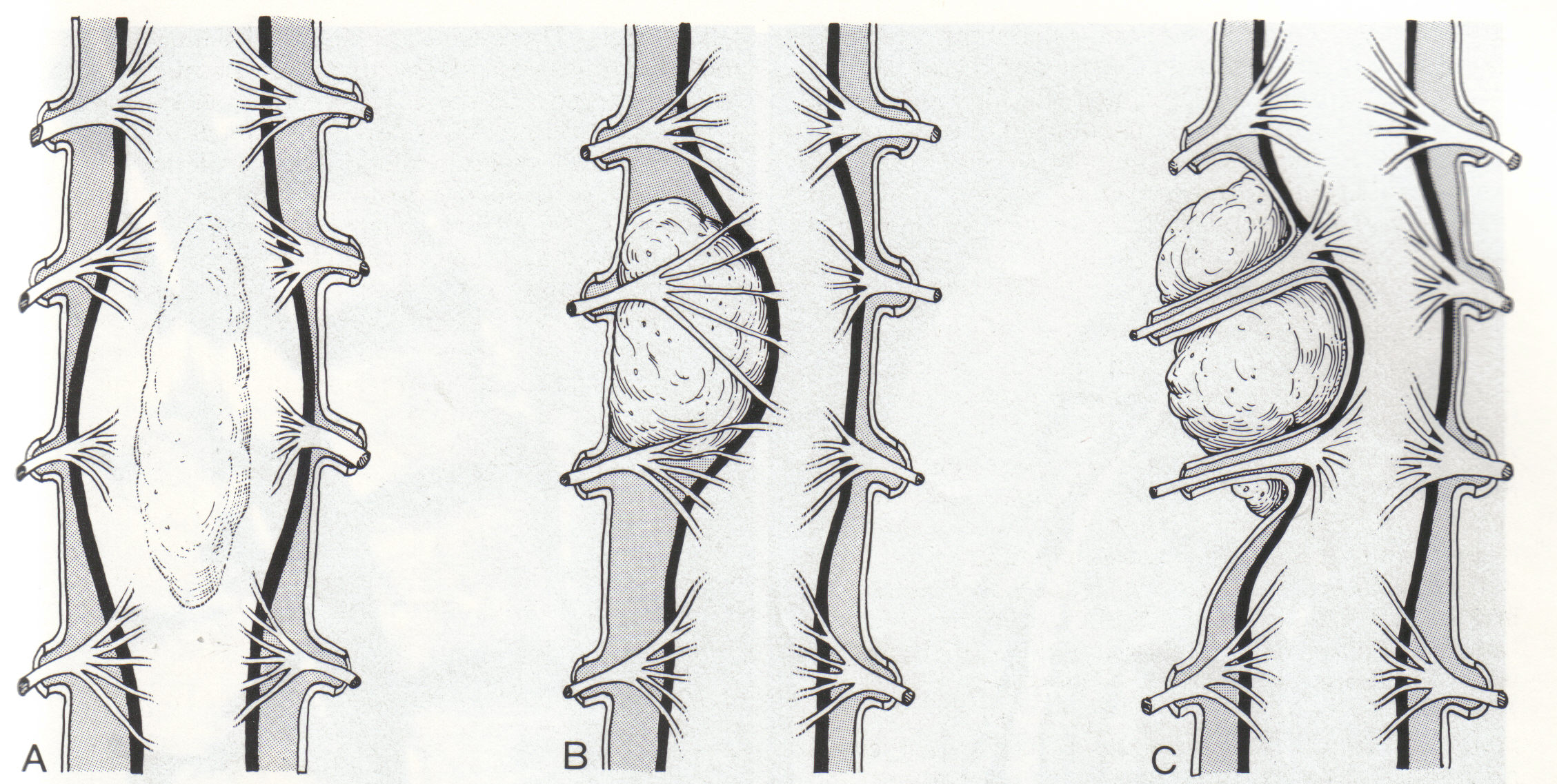 Spinal Cord Tumor