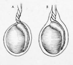 Testicular Torsion